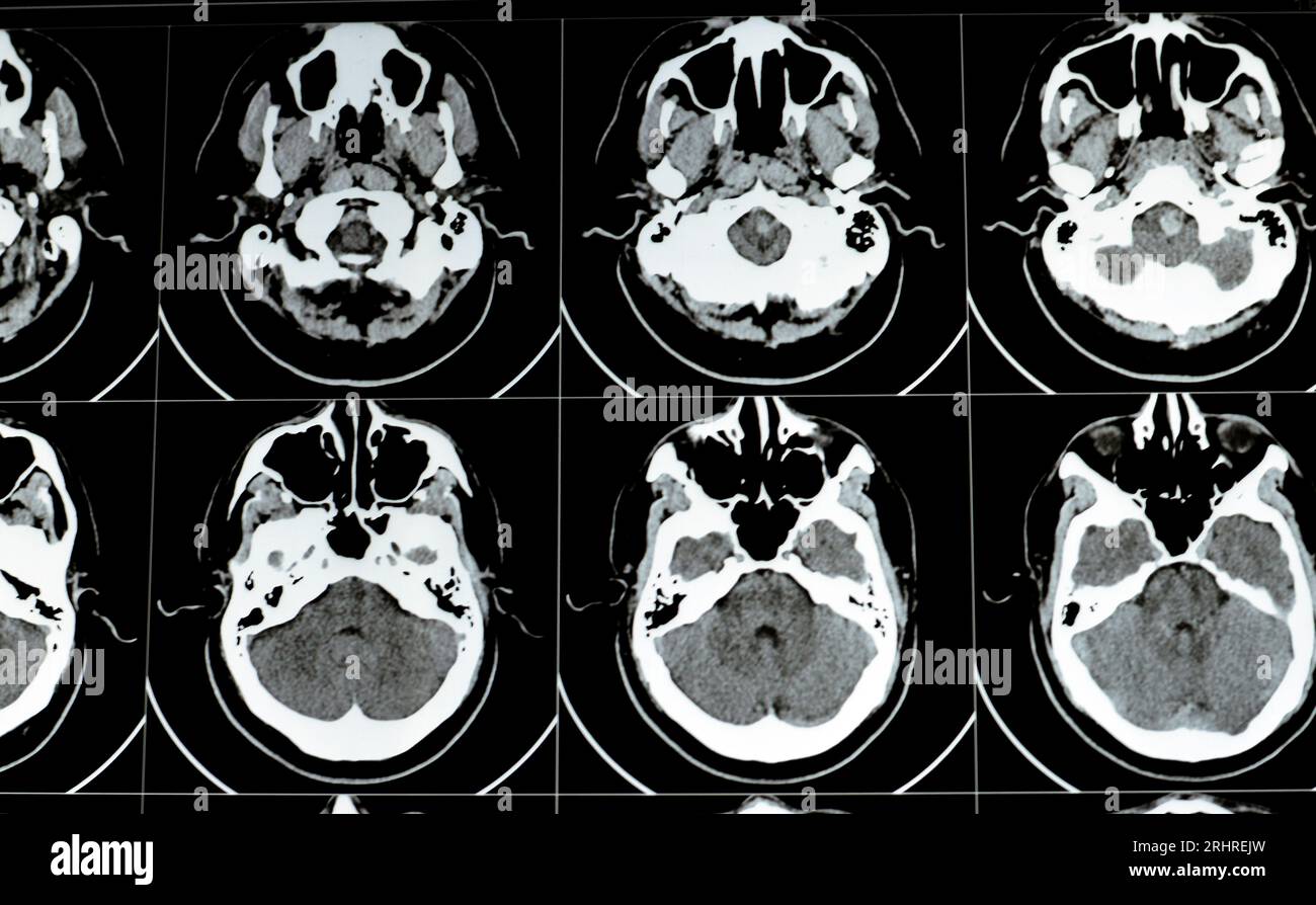 Abnormales ct des kopfes -Fotos und -Bildmaterial in hoher Auflösung ...