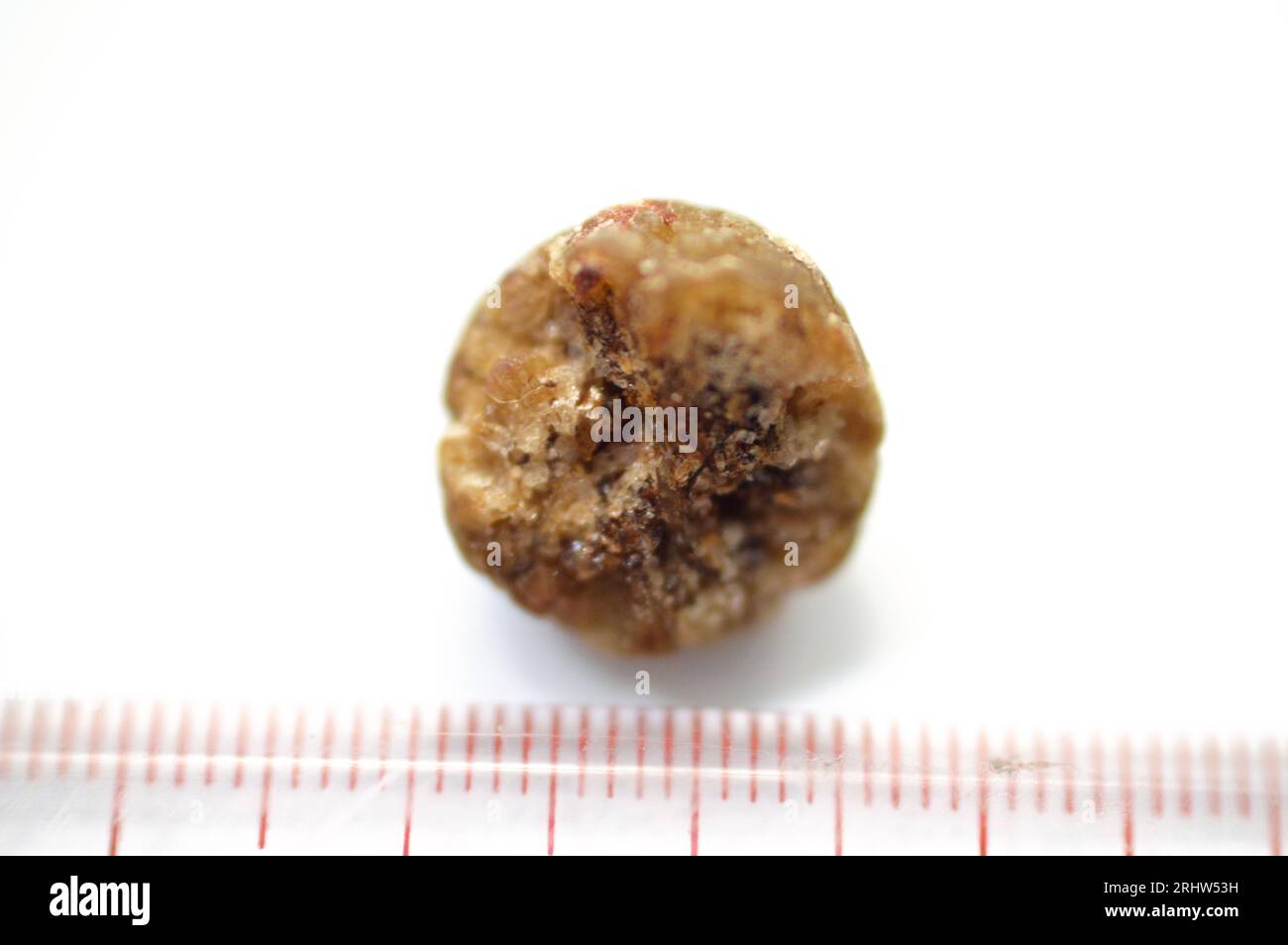 Große Gallensteine, die nach laparoskopischer Cholezystektomie ...