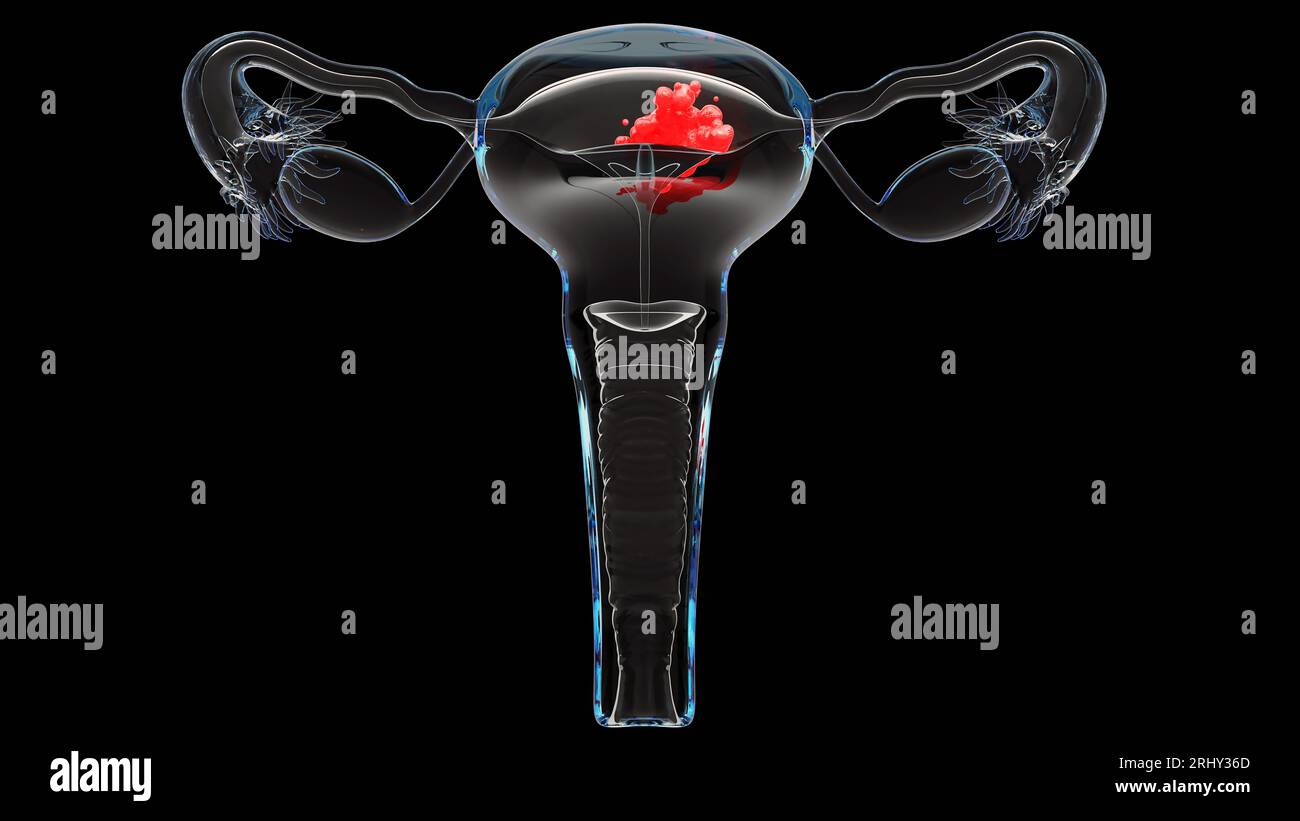 Uterus Malignant Tumor Female Uterus Anatomy Reproductive System