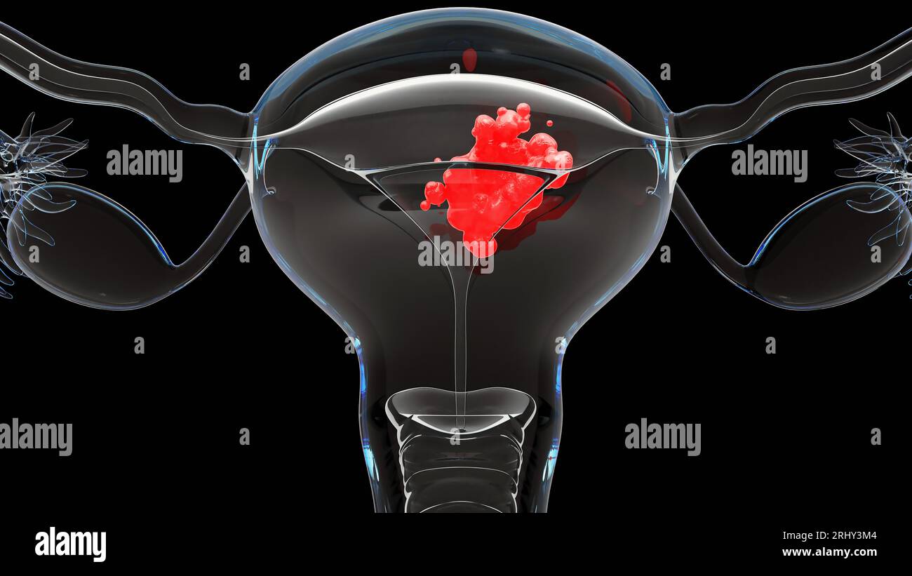 Uterus Malignant Tumor Female Uterus Anatomy Reproductive System