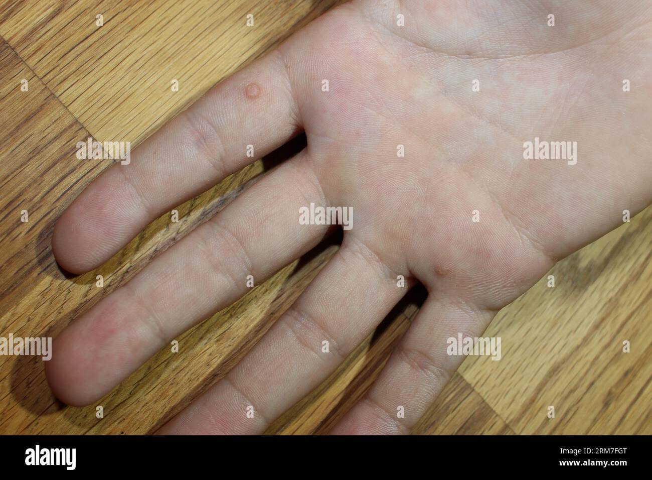 Warzen hand -Fotos und -Bildmaterial in hoher Auflösung – Alamy