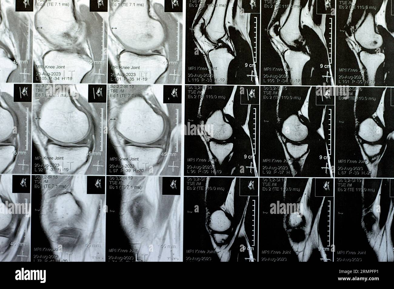 Anterior cruciate ligament anatomy -Fotos und -Bildmaterial in hoher ...