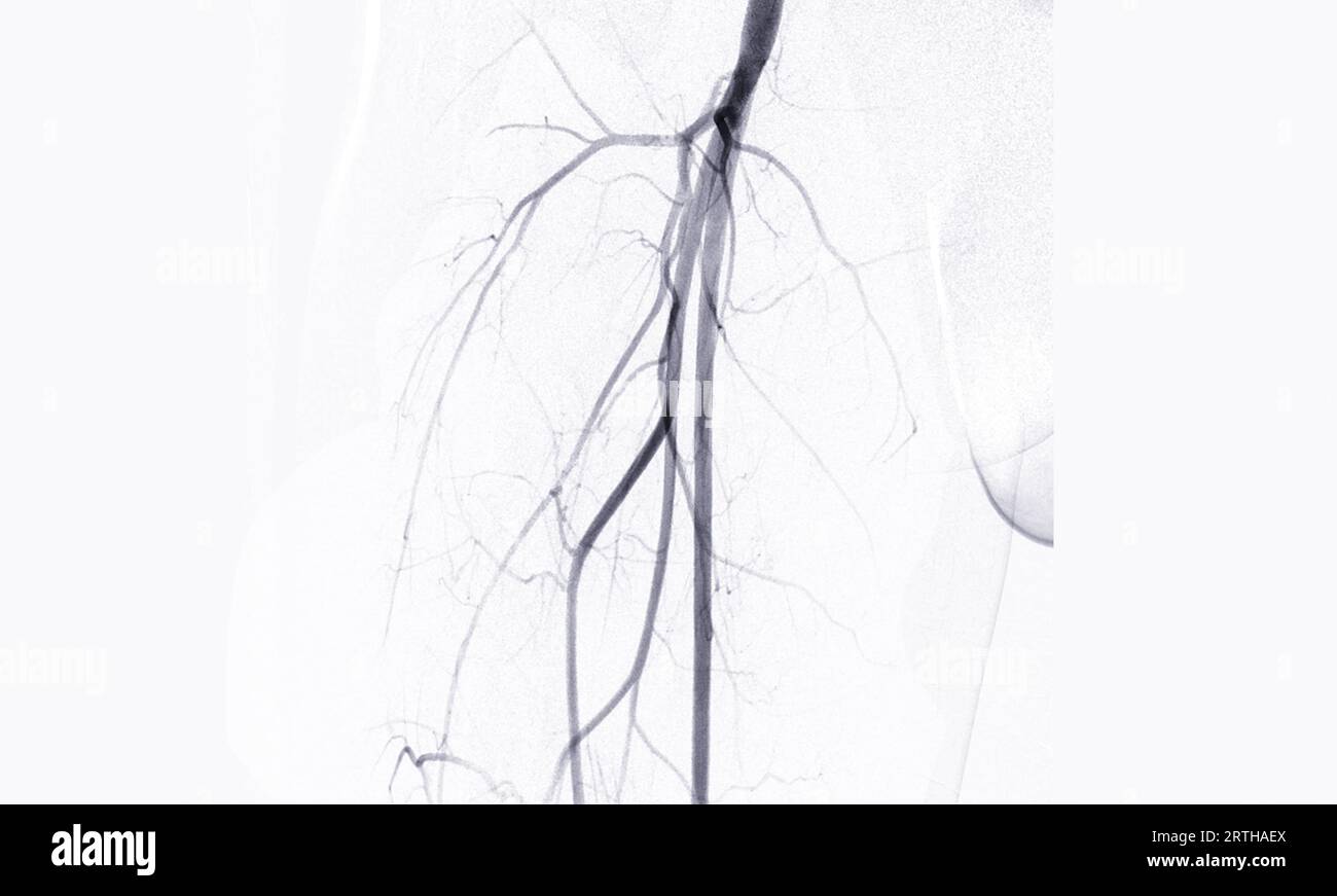 Angiogram of the abdominal aorta -Fotos und -Bildmaterial in hoher ...