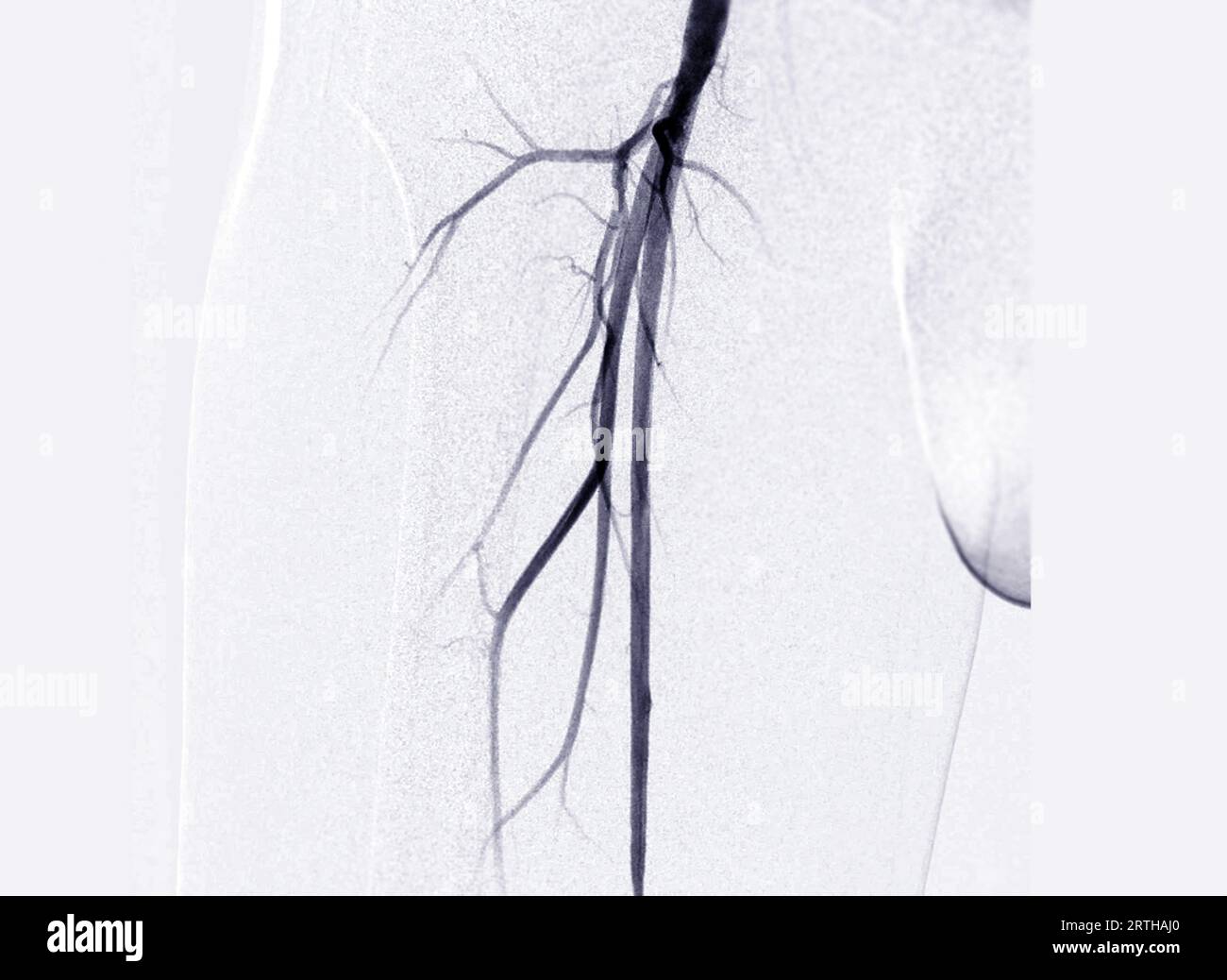 Angiogram of the abdominal aorta -Fotos und -Bildmaterial in hoher ...