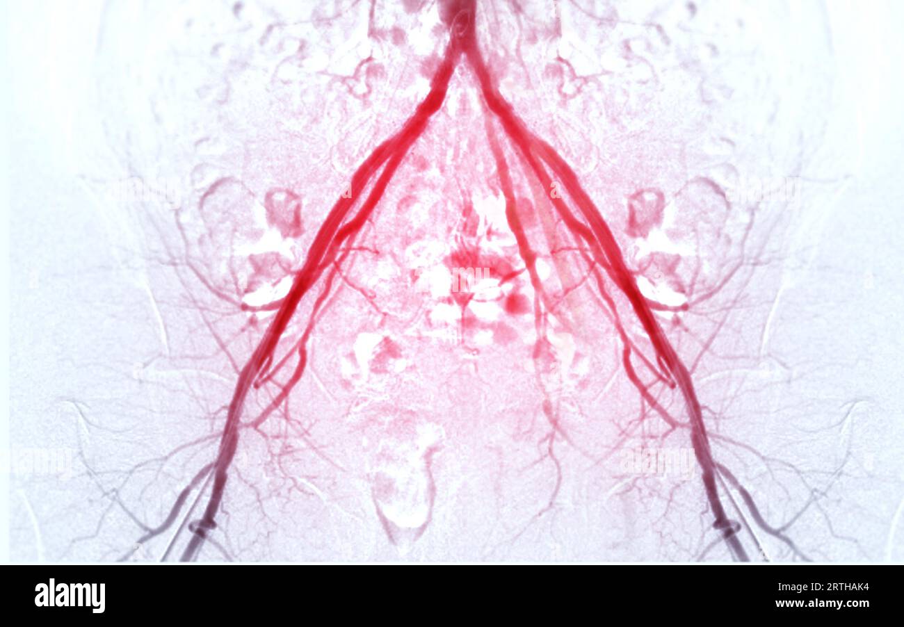 Angiogram of the abdominal aorta -Fotos und -Bildmaterial in hoher ...