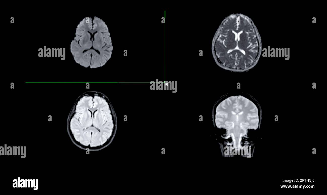 Axial mri -Fotos und -Bildmaterial in hoher Auflösung - Seite 5 - Alamy