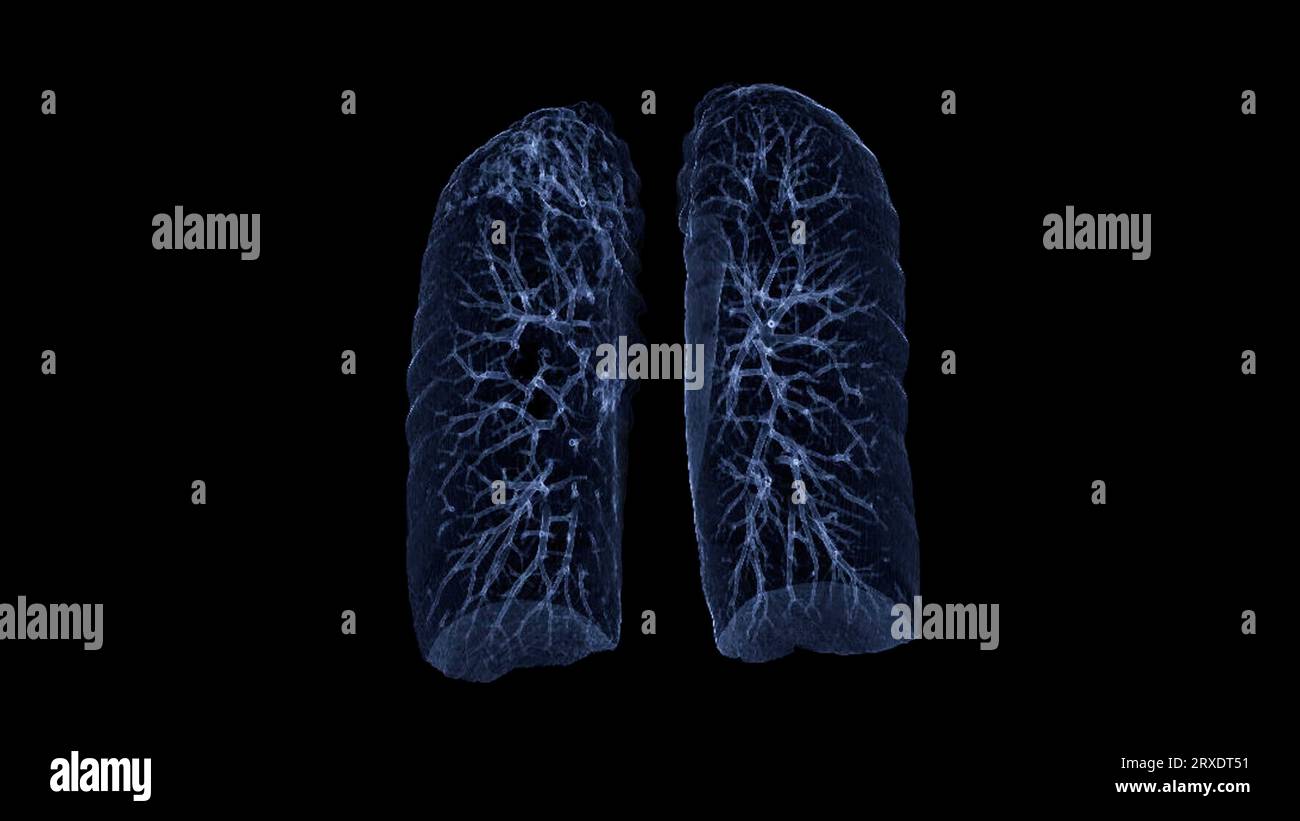 CT-Thorax- oder CT-Lungen-3D-Rendering-Bild mit blauer Farbe, das ...