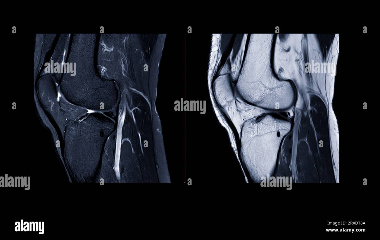 Magnetresonanztomographie des Kniegelenkes oder MRT-Kniesagittal zum ...