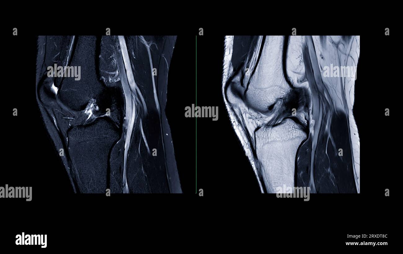 Magnetresonanztomographie des Kniegelenkes oder MRT-Kniesagittal zum Nachweis von Rissen oder ...