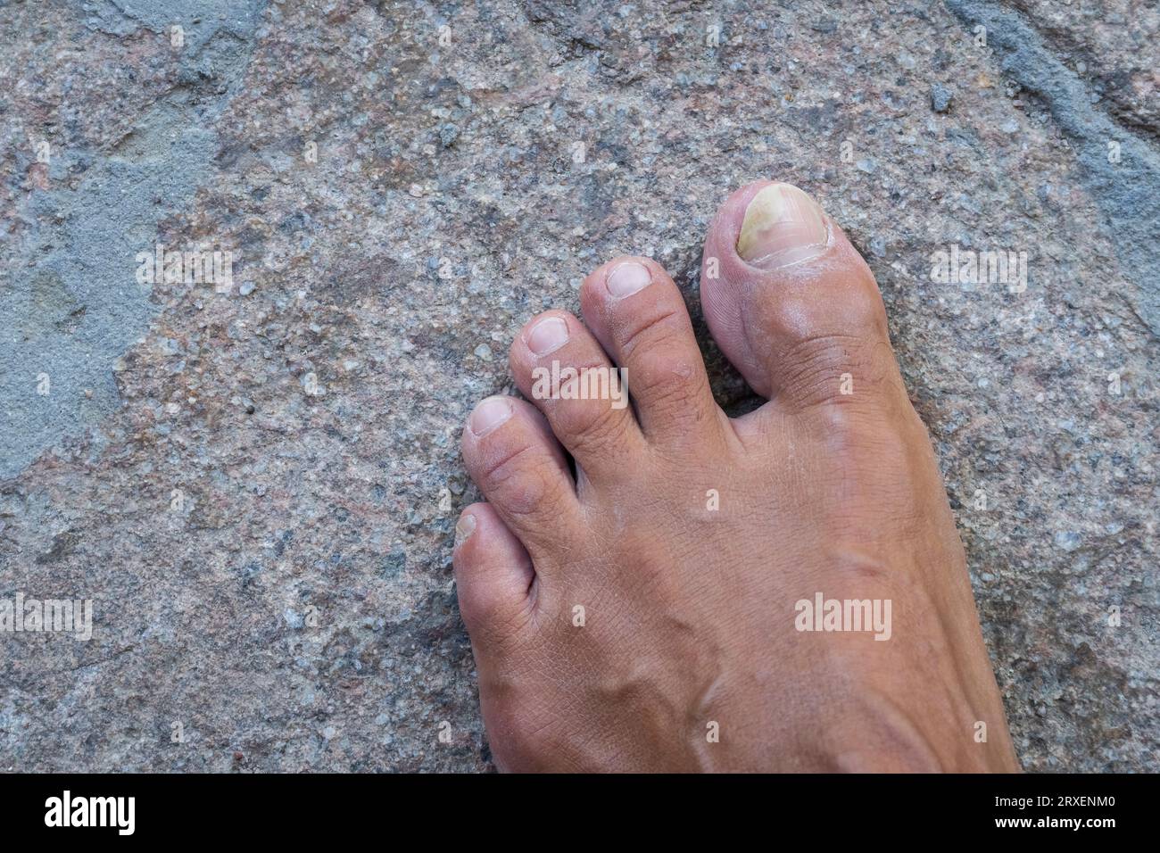 Zehennägel mit Pilzproblemen,Onychomykose, auch bekannt als Tinea ...