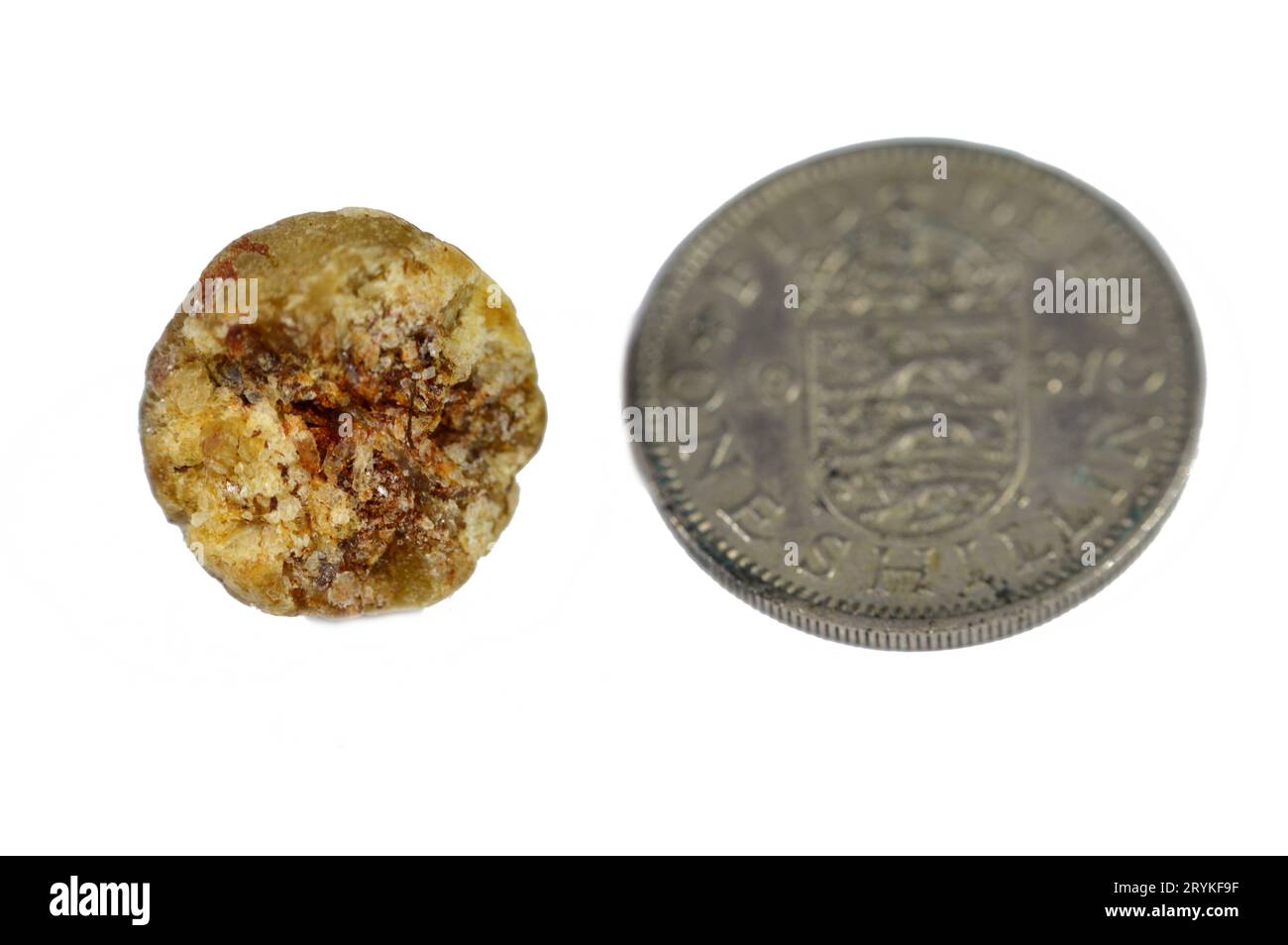 Große Gallensteine, die nach laparoskopischer Cholezystektomie ...