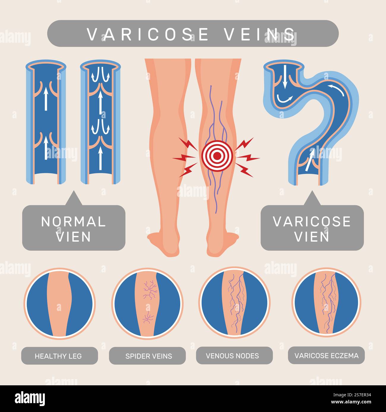 Venöse Probleme. Infografik-Vorlage der venösen Erkrankung Blutschema ...
