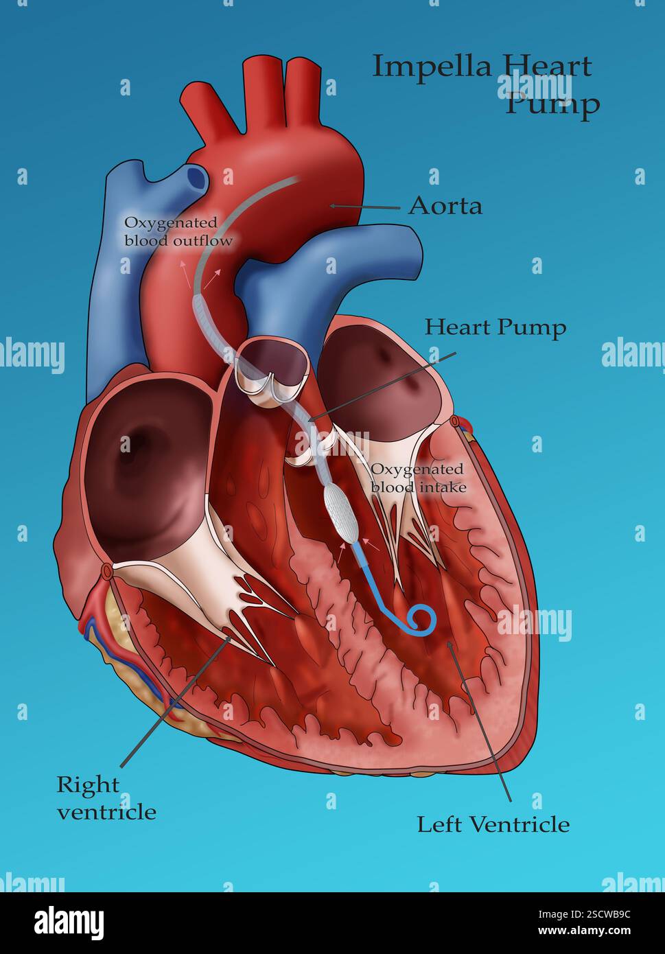 Impella herzpumpe in der linken herzkammer dargestellt -Fotos und -Bildmaterial in hoher ...