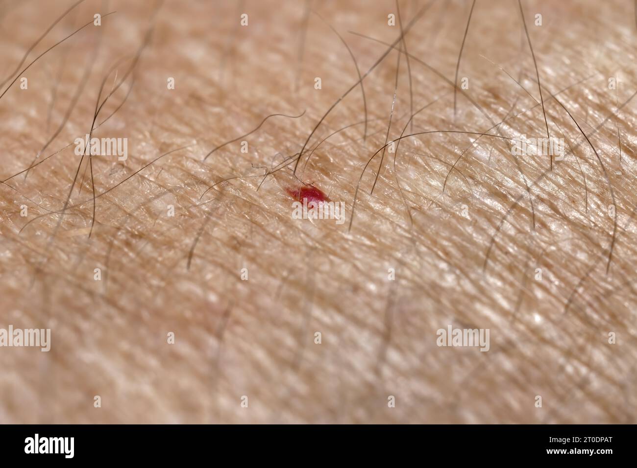 Rote Muttermale, auch bekannt als Rubinpunkte oder Blutmale, erscheinen ...