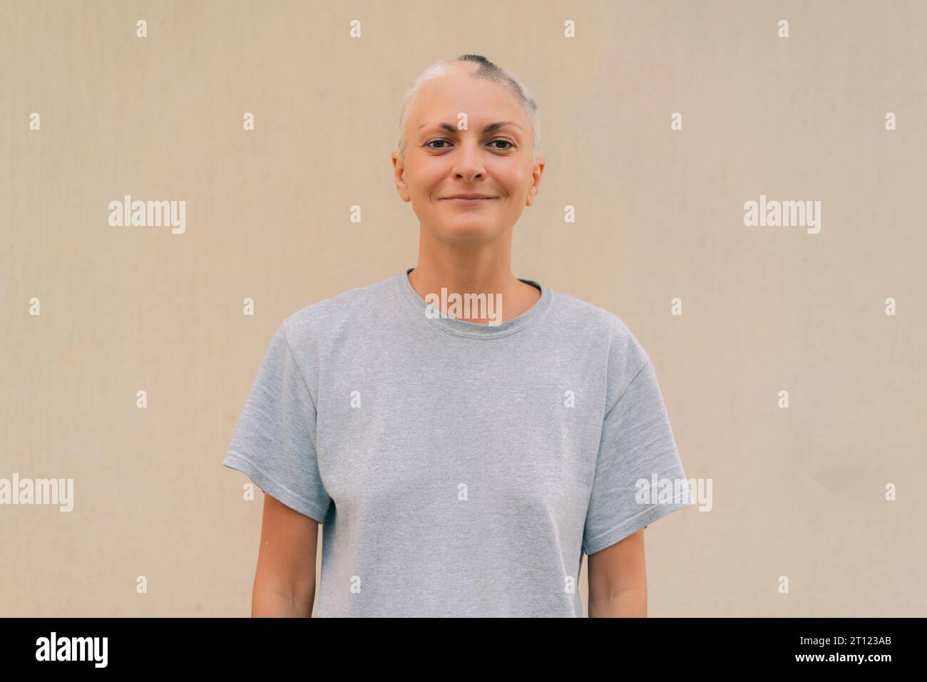 Echte Alopecia areata bei einem jungen Mädchen. Ein kahler Kopf in einer Person. Diffuse ...