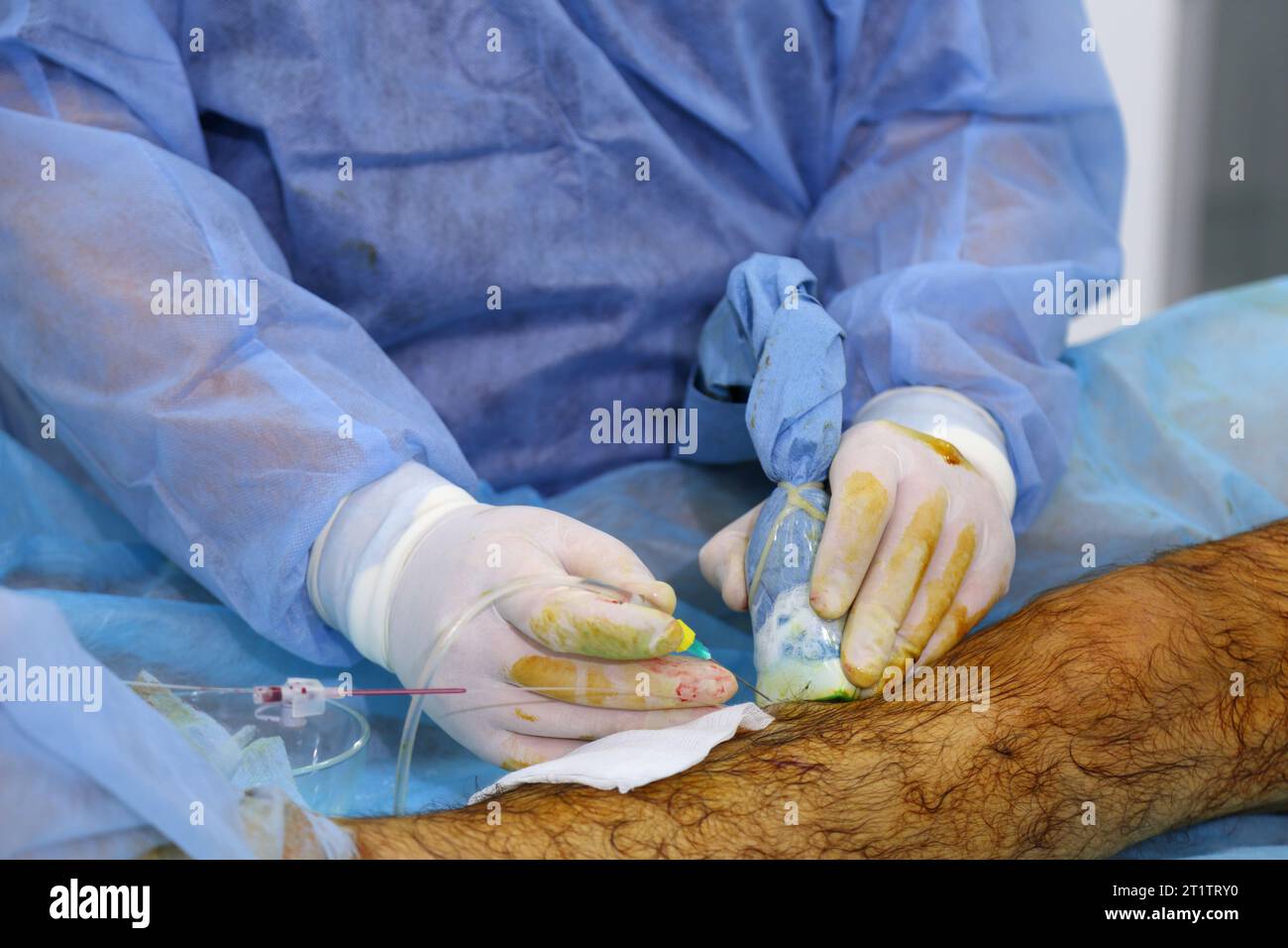 Medizinische Chirurgie bei endovenöser Laserphotokoagulation der Vena ...