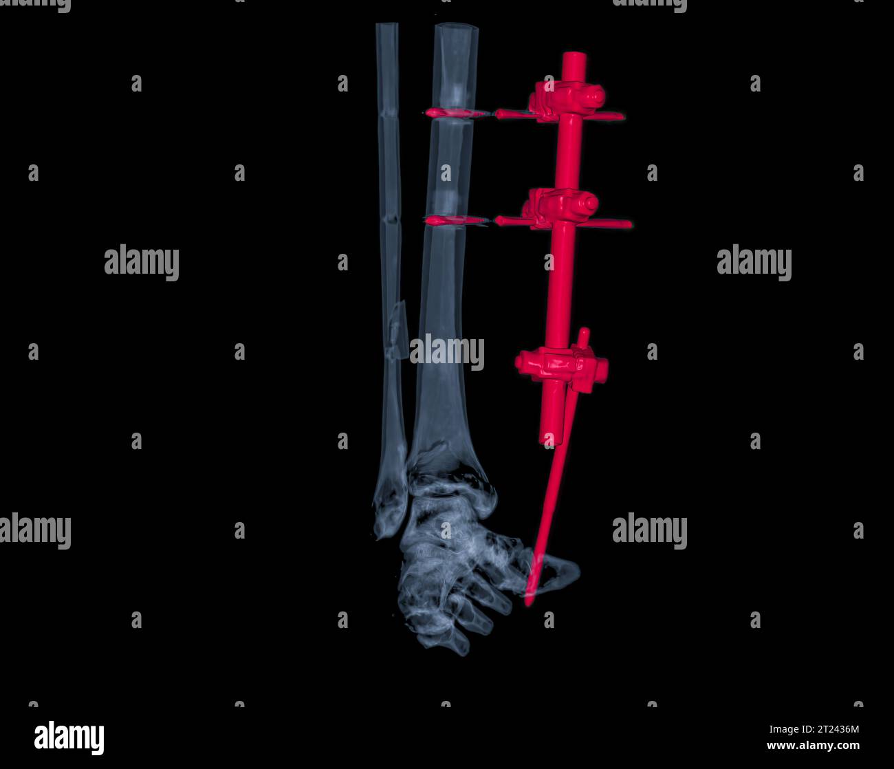 CT Scan 3D-Rendering-Bild mit Frakturen an Tibia und Fibula mit Platte ...