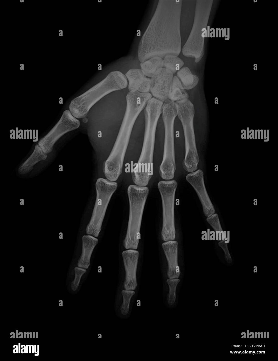 Normal x ray the hand -Fotos und -Bildmaterial in hoher Auflösung – Alamy
