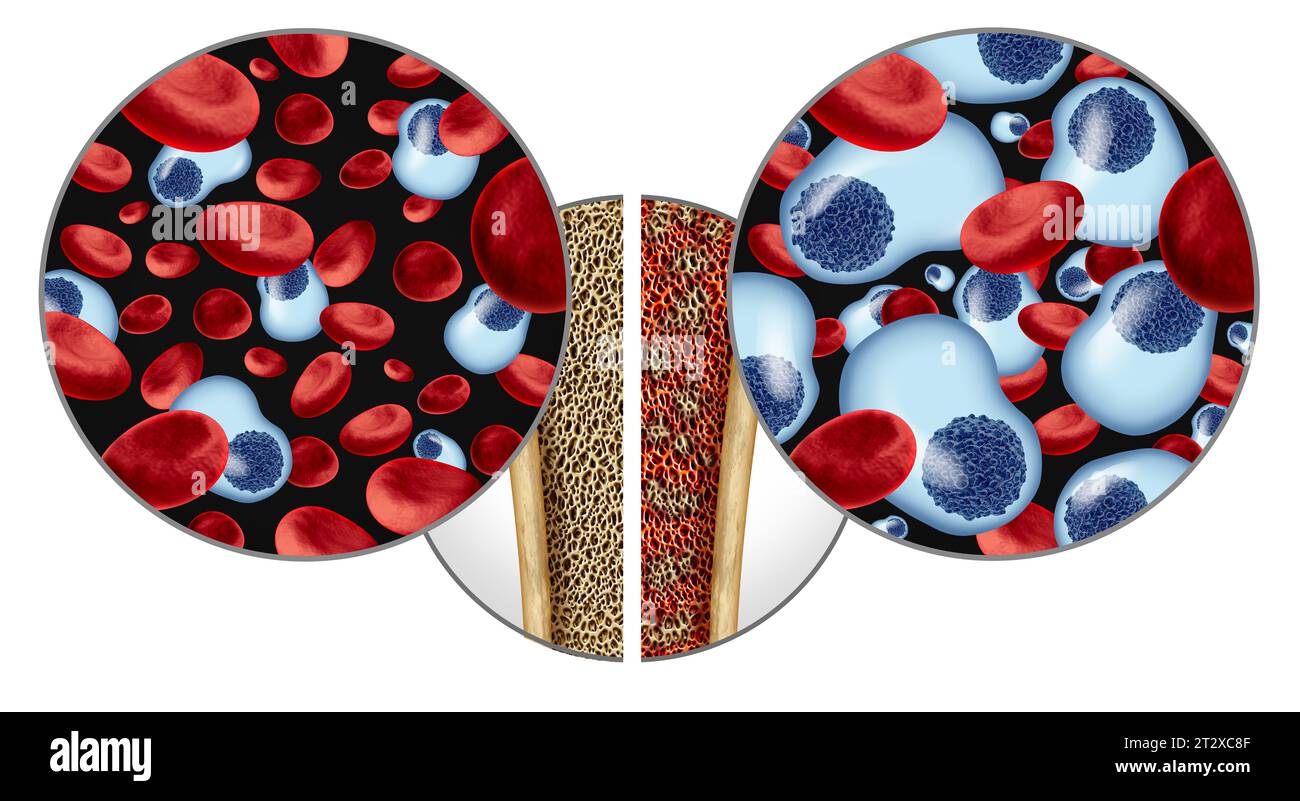 Krebsartige plasmazellen -Fotos und -Bildmaterial in hoher Auflösung ...