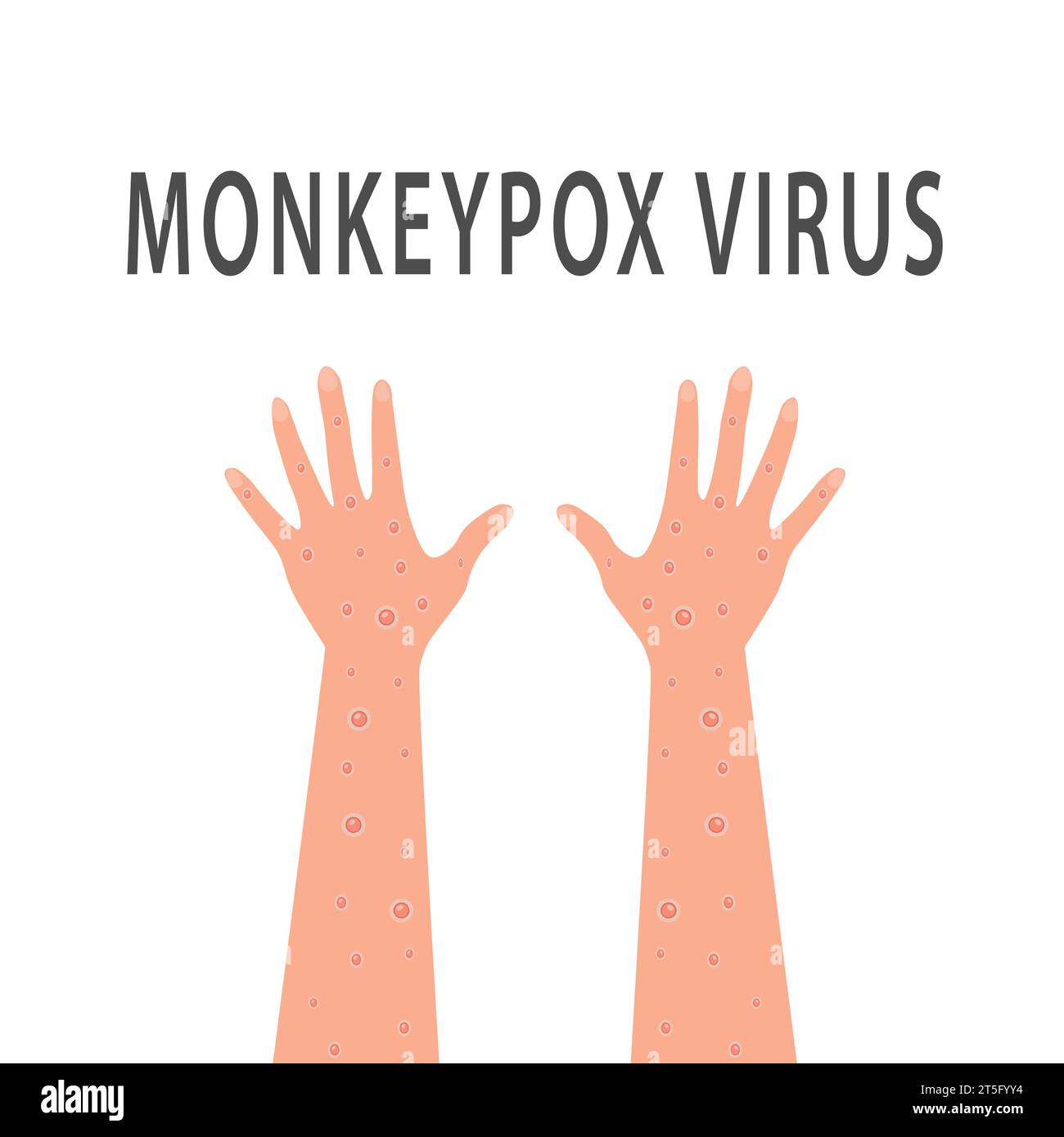 Affenpocken krankheit Stock-Vektorgrafiken kaufen - Alamy