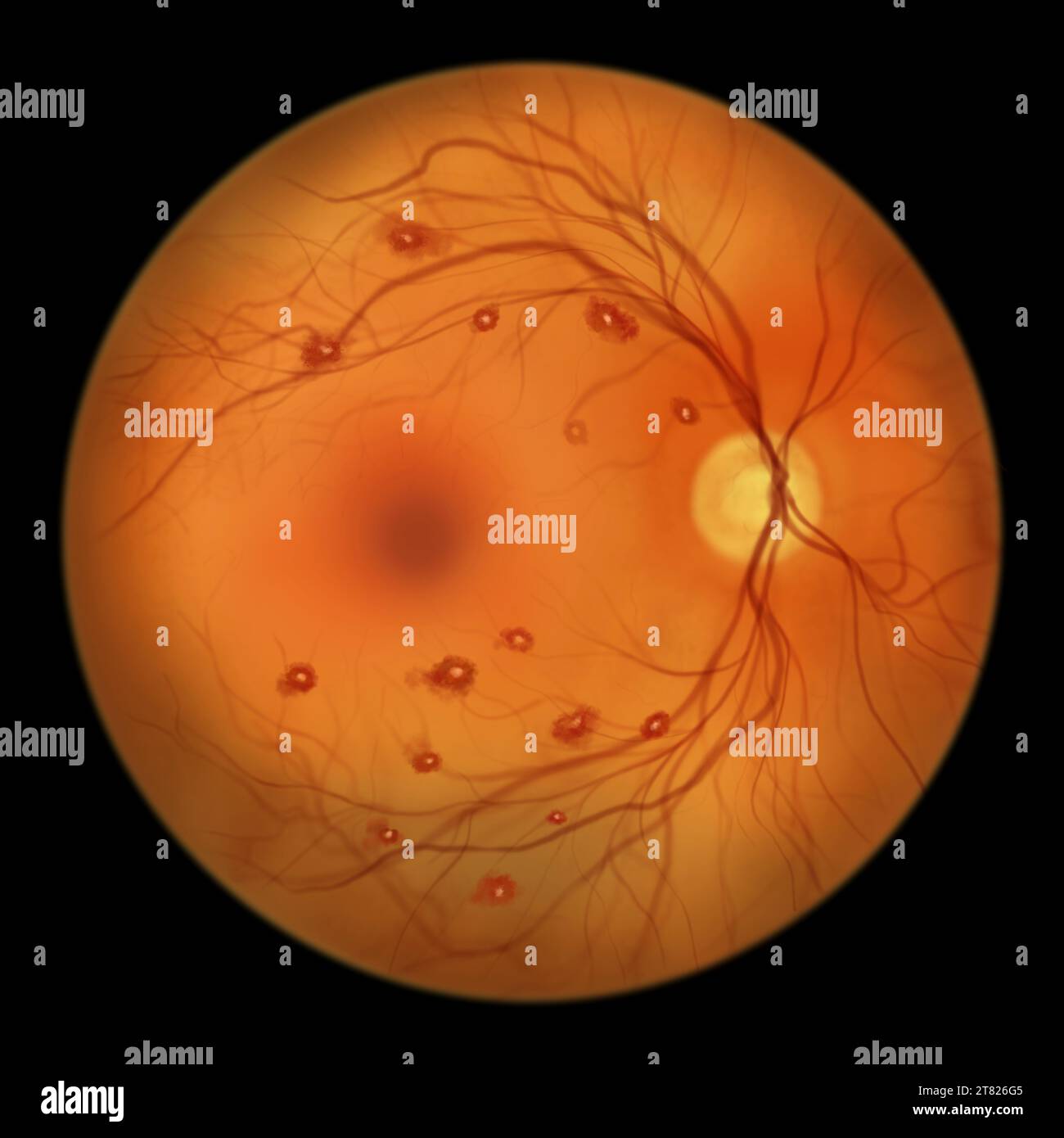 Roth Flecken in der Netzhaut, Illustration Stockfotografie - Alamy