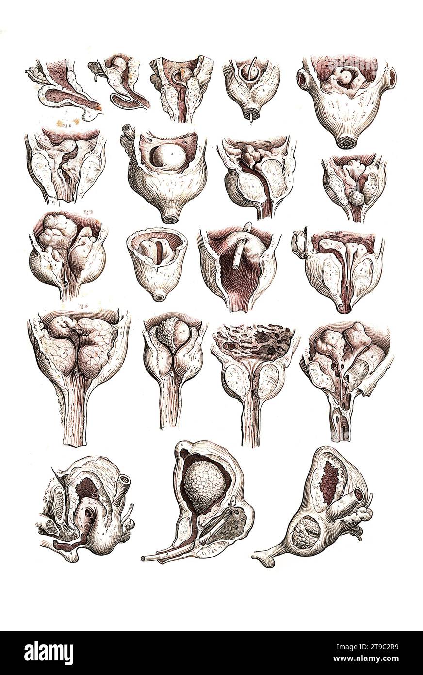 Prostate anatomy -Fotos und -Bildmaterial in hoher Auflösung – Alamy