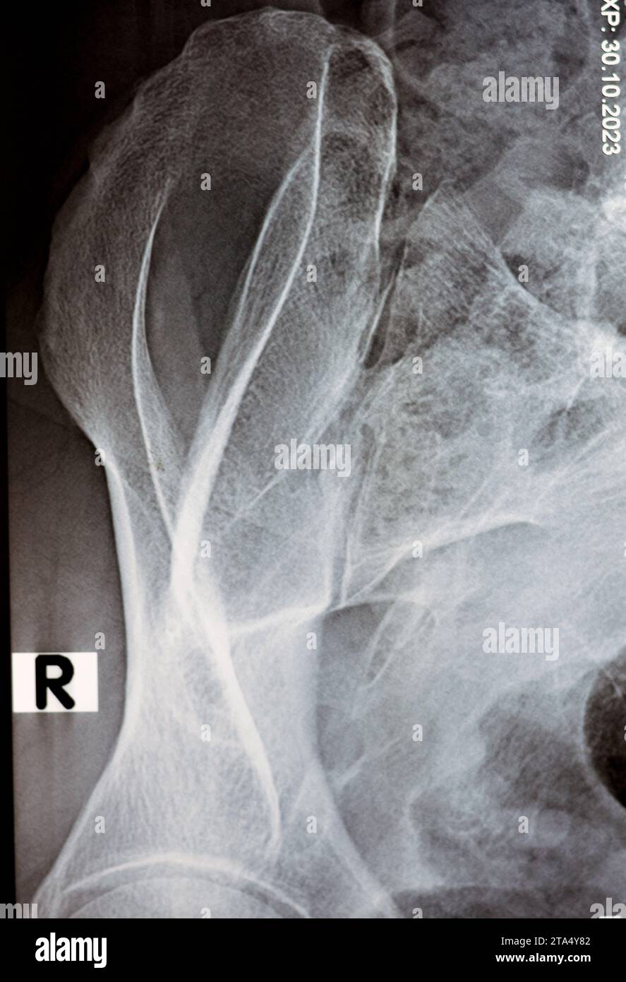 Sacroiliac joints -Fotos und -Bildmaterial in hoher Auflösung – Alamy