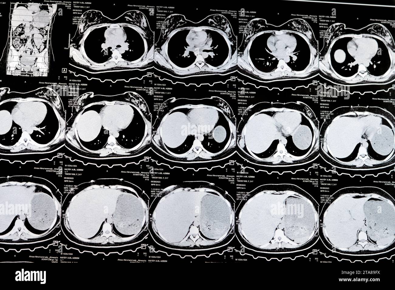 Ct scan der leber -Fotos und -Bildmaterial in hoher Auflösung – Alamy