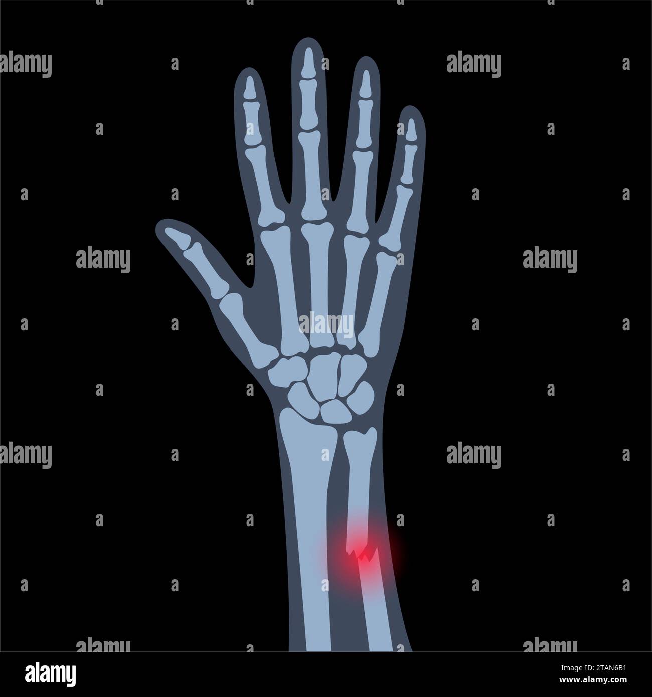 Fracture of the arm -Fotos und -Bildmaterial in hoher Auflösung – Alamy