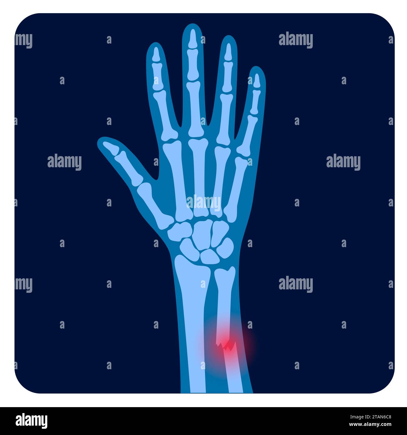 Fracture of the arm -Fotos und -Bildmaterial in hoher Auflösung – Alamy