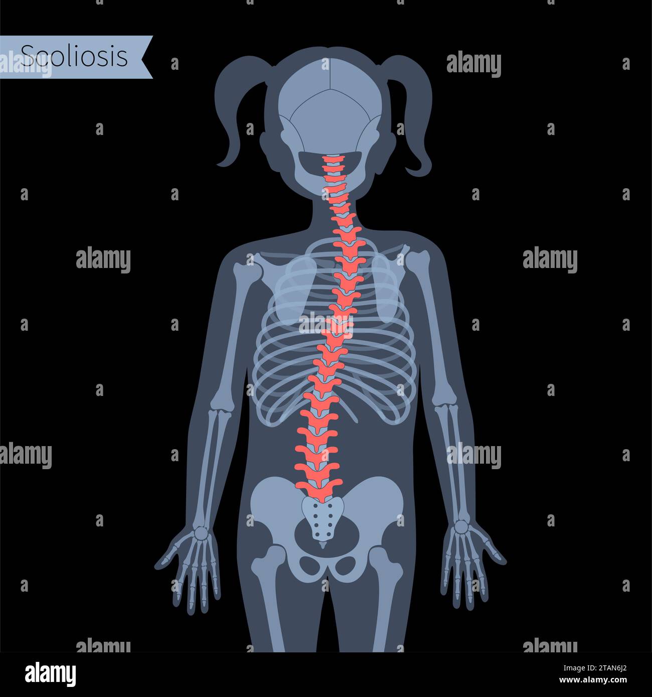 Skoliose kinder -Fotos und -Bildmaterial in hoher Auflösung – Alamy