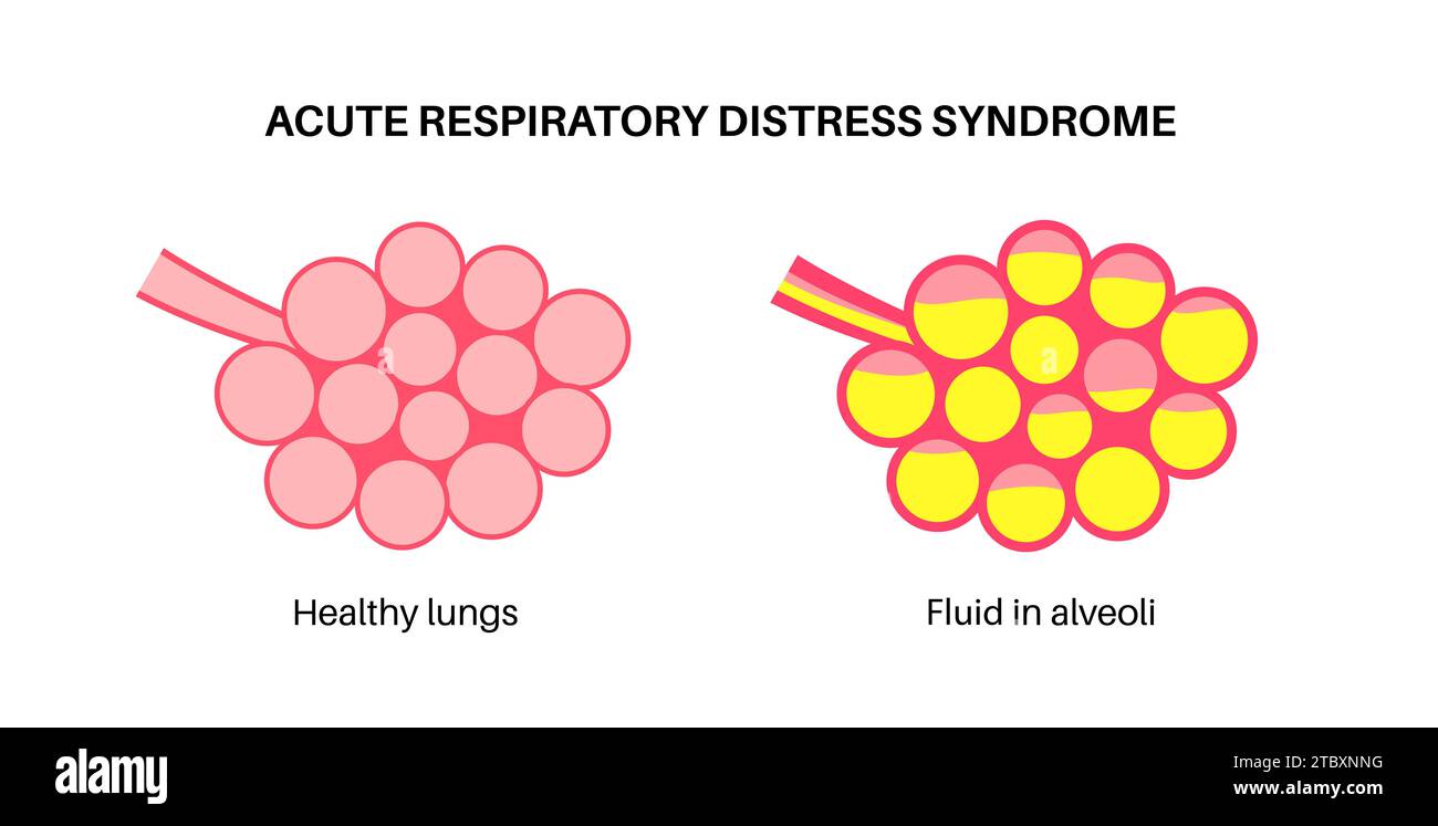 Respirazione della membrana alveolare -Fotos und -Bildmaterial in hoher ...