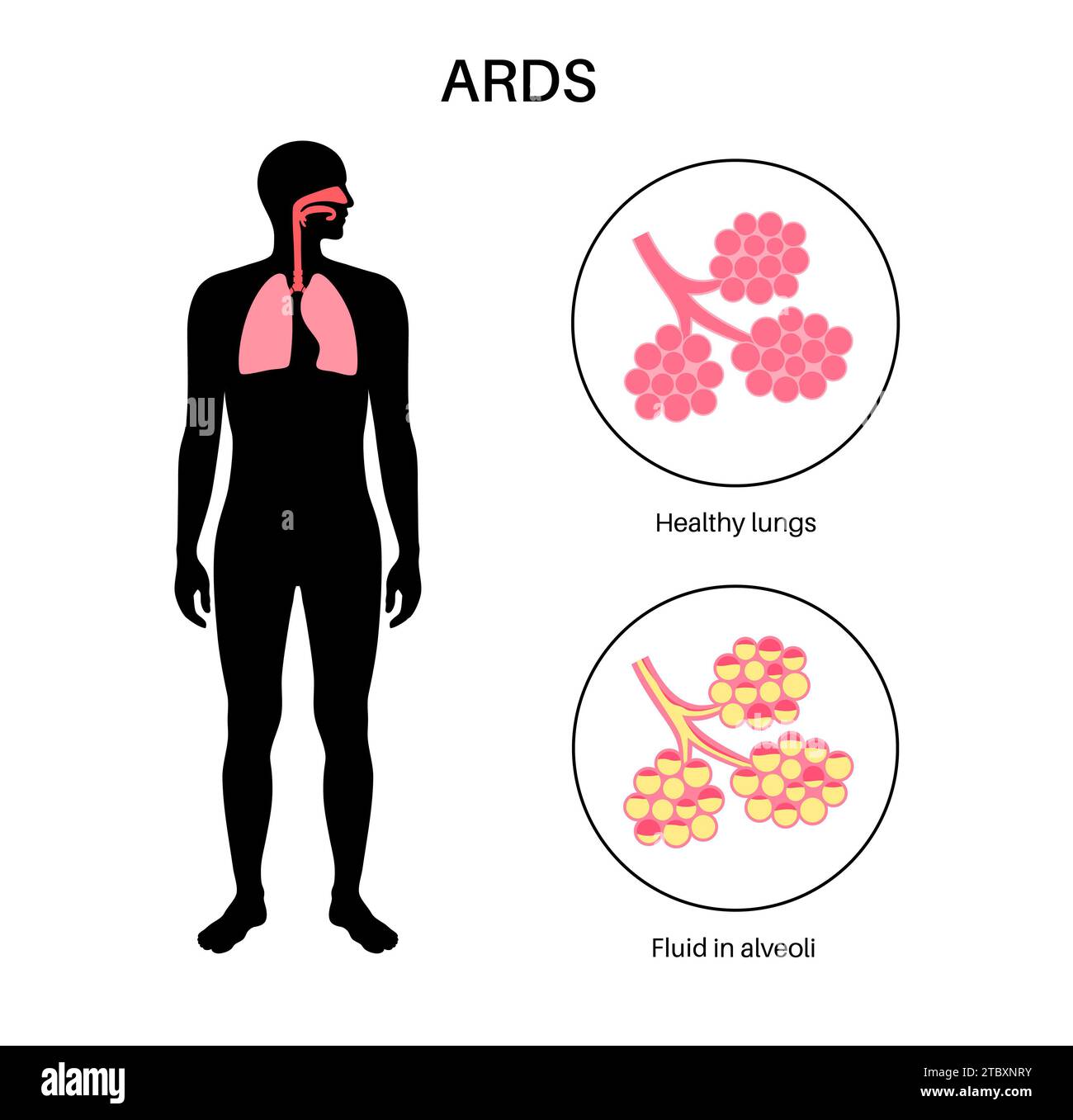 Respirazione della membrana alveolare -Fotos und -Bildmaterial in hoher ...