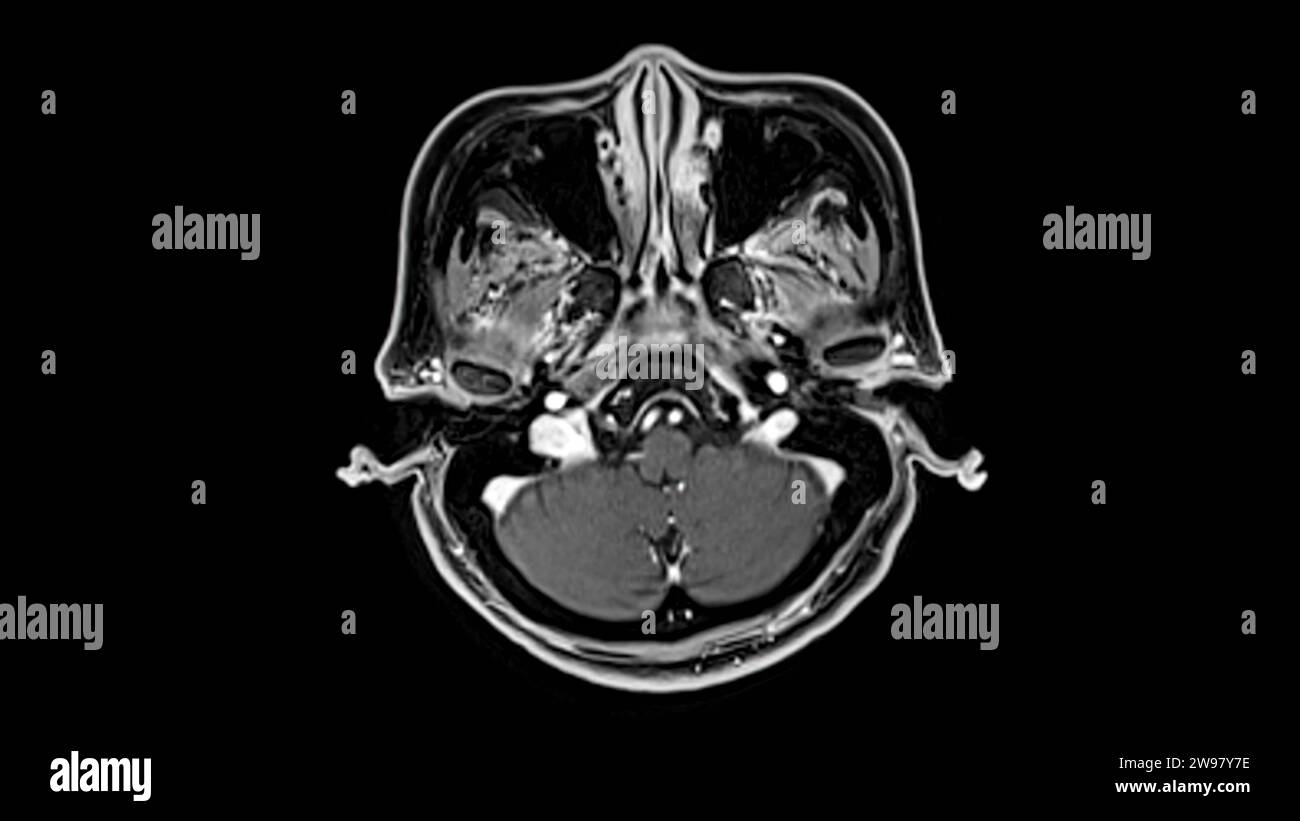 Die axiale Ansicht von MRT-Hirnscans bietet wertvolle Einblicke in ...