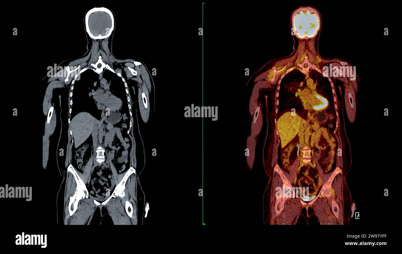 PET CT-Scan-Fusion-Bild es liefert detaillierte Bilder, indem die Stoffwechselaktivität aus PET ...