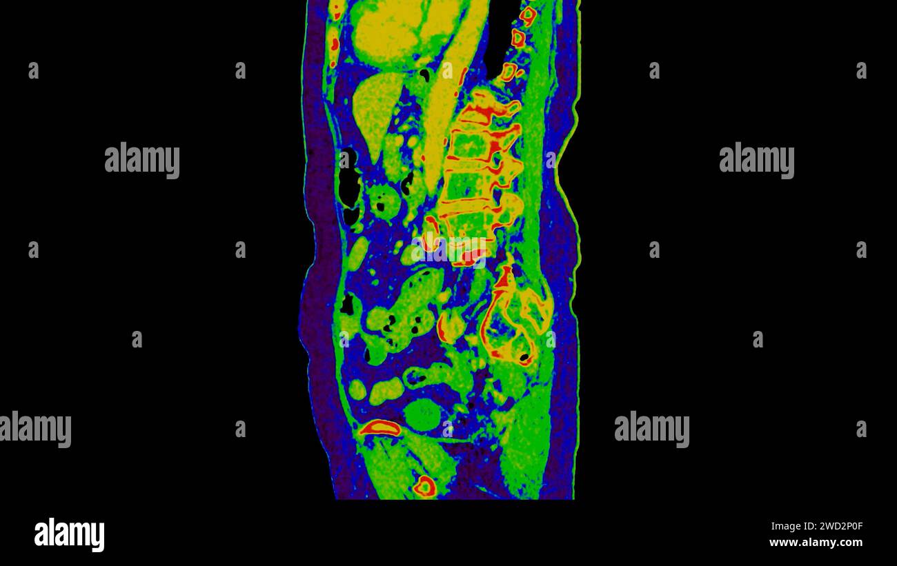Abdominal ct scan abdomen -Fotos und -Bildmaterial in hoher Auflösung ...