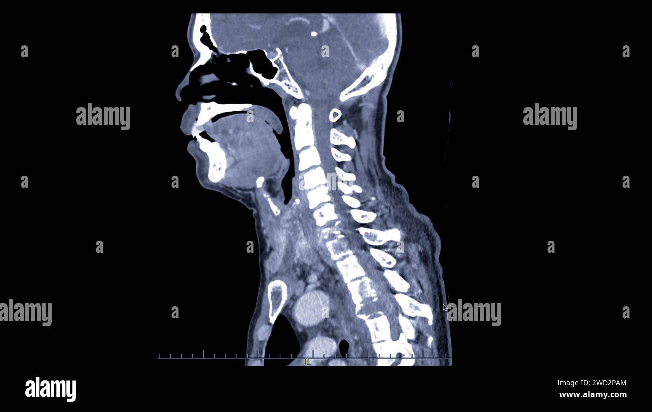 Ein CT-Scan der sagittalen Halsansicht für diagnostische Verfahren ist ... Ein CT-Scan der sagittalen Halsansicht für diagnostische Verfahren ist ...