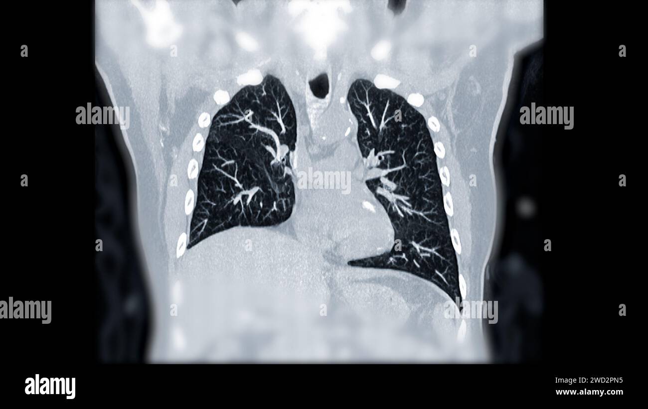 Human lung angiogram -Fotos und -Bildmaterial in hoher Auflösung – Alamy
