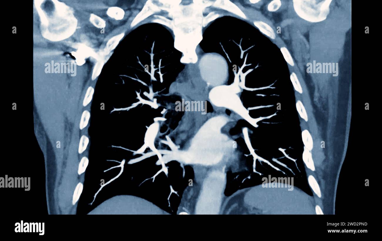 CTPA oder CTA Pulmonalarterie. Diese Bildgebungstechnik bietet eine ...
