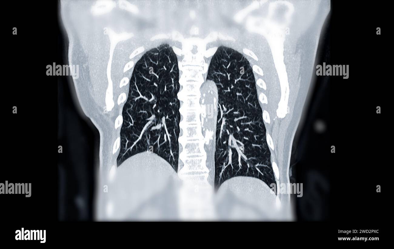 CTPA oder CTA Pulmonalarterie. Diese Bildgebungstechnik bietet eine ...
