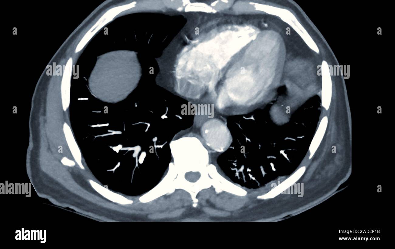 CTPA oder CTA Pulmonalarterie. Diese Bildgebungstechnik bietet eine klare Sicht auf die ...