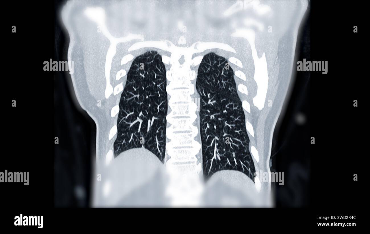 CTPA oder CTA Pulmonalarterie. Diese Bildgebungstechnik bietet eine klare Sicht auf die ...