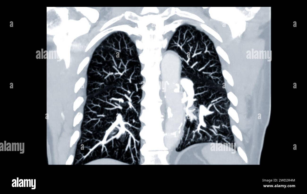 CTPA oder CTA Pulmonalarterie. Diese Bildgebungstechnik bietet eine klare Sicht auf die ...