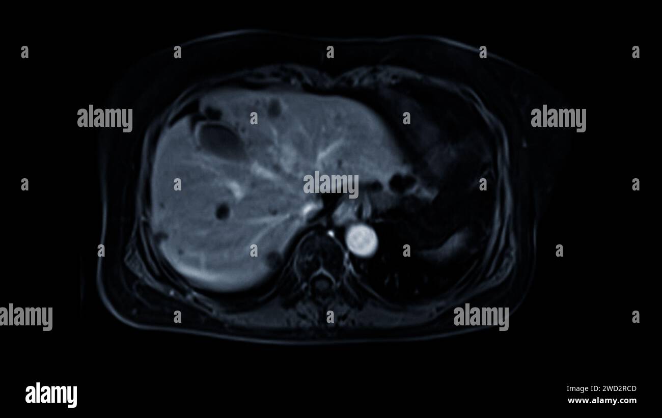 Die MRT der axialen Ansicht des Oberbauches ist eine nicht-invasive ...