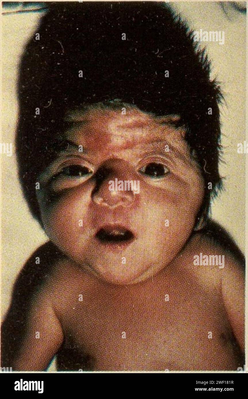 Apert syndrom -Fotos und -Bildmaterial in hoher Auflösung – Alamy