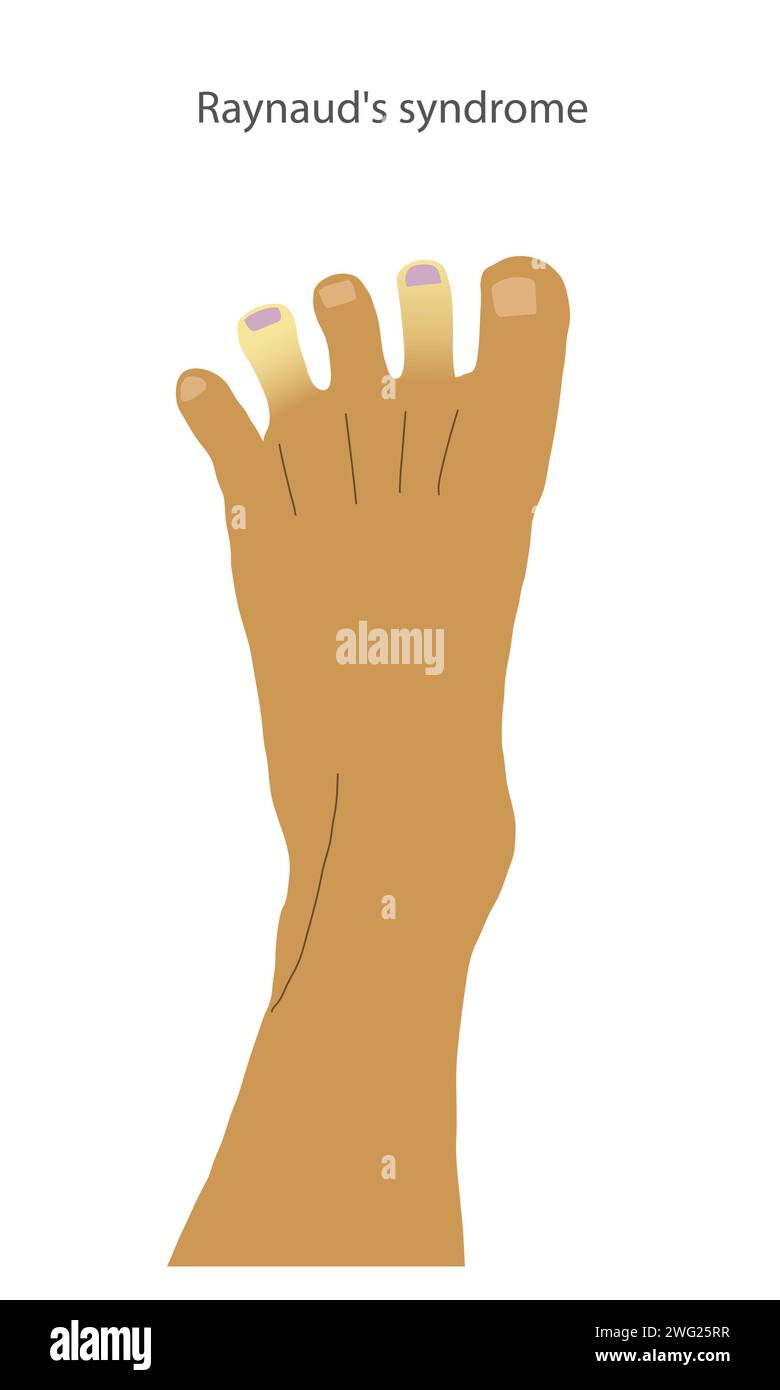 Ein Fuß mit Raynaud-Syndrom-Symptomen an den Zehenspitzen. Periphere ...