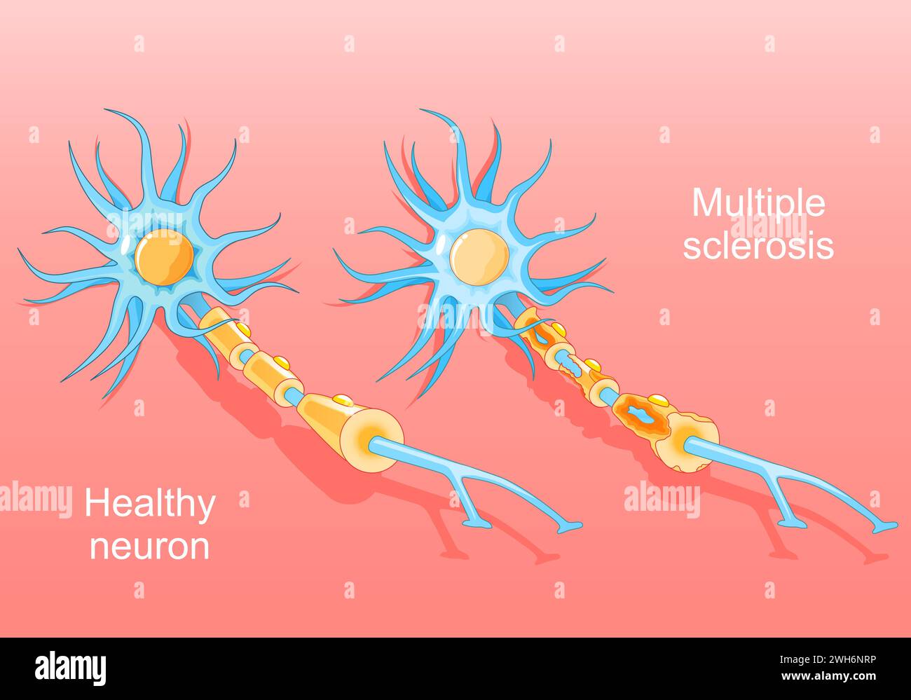 Multiple sklerose und nerven Stock-Vektorgrafiken kaufen - Alamy