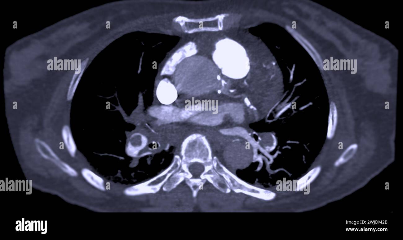 Eine CTA-Pulmonalarterie zeigt eine detaillierte Ansicht der ...