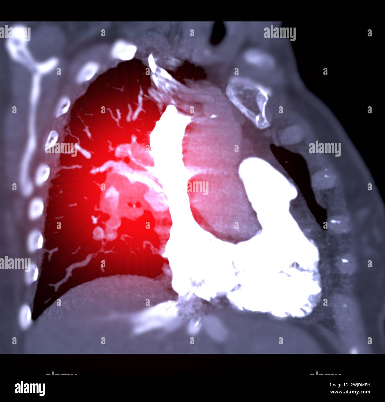 Truncus pulmonalis -Fotos und -Bildmaterial in hoher Auflösung – Alamy