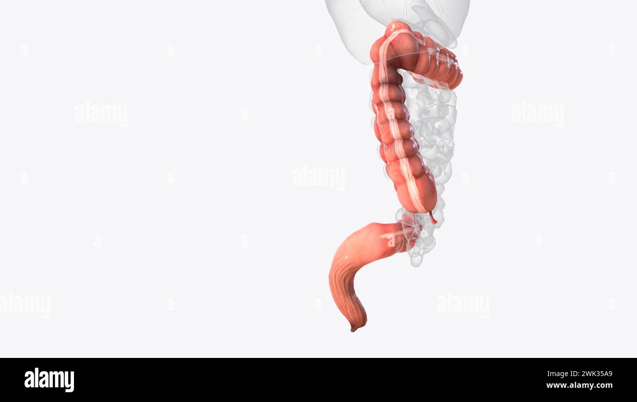 Bowel perforation -Fotos und -Bildmaterial in hoher Auflösung – Alamy